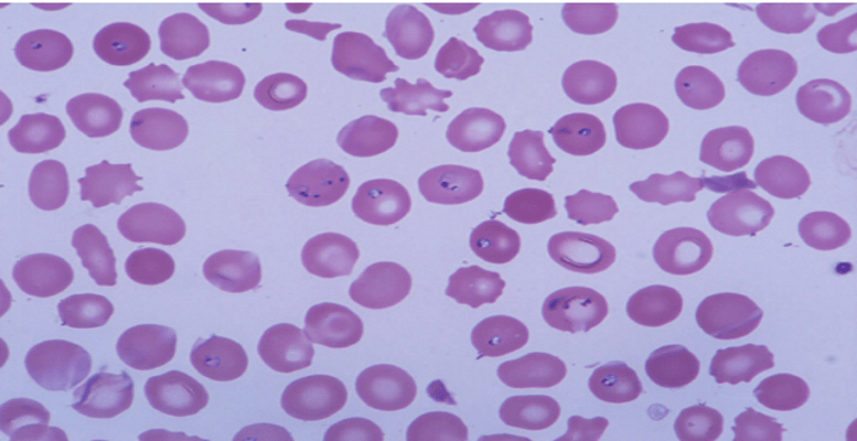 Monosit (Mon) Nedir, Değeri, Yüksekliği, Düşüklüğü, Tedavisi | Obezite ...